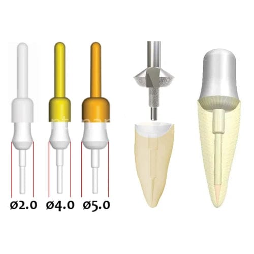 Fiber Site Post – Buy Dental products Online DentalMantraa